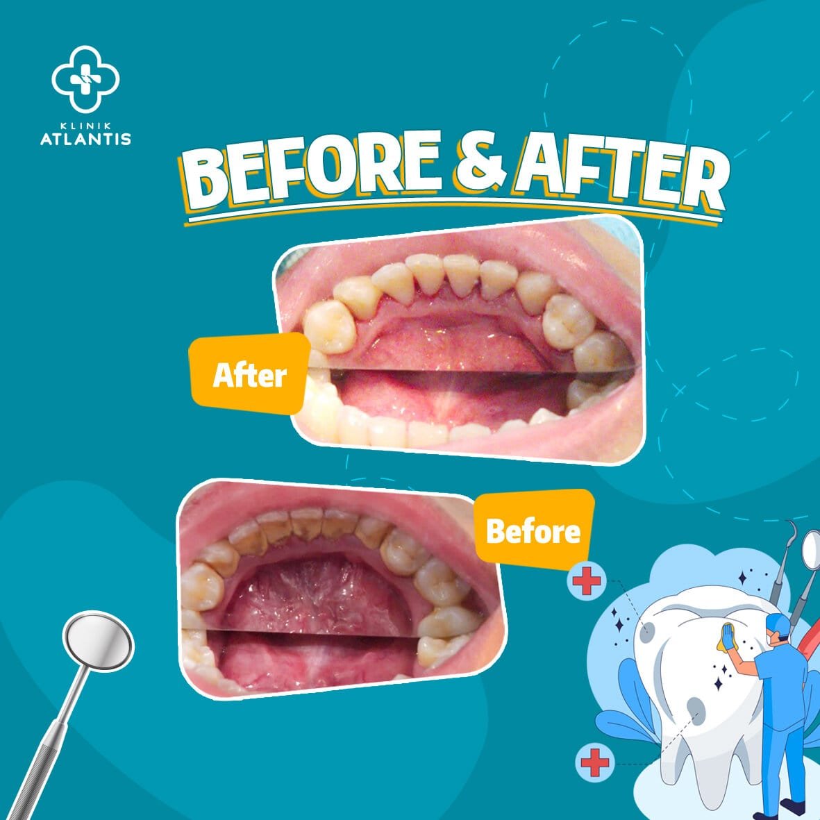 SCALING GIGI UNTUK KESEHATAN GIGI DAN MULUT - Klinik Atlantis